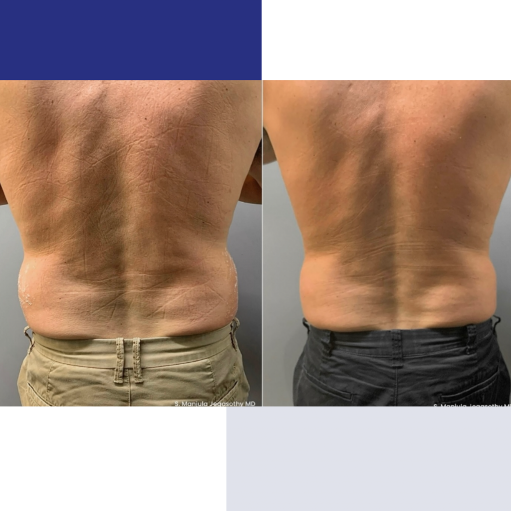 Kybella ® Fat Dissolving Injections| Miami Skin Institute